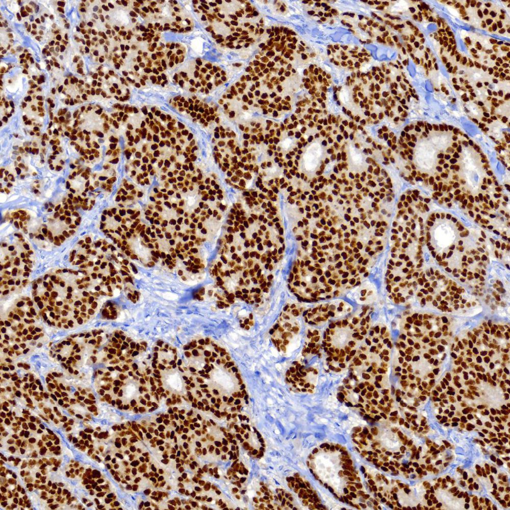 Breast ca stained with Anti-Estrogen Receptor