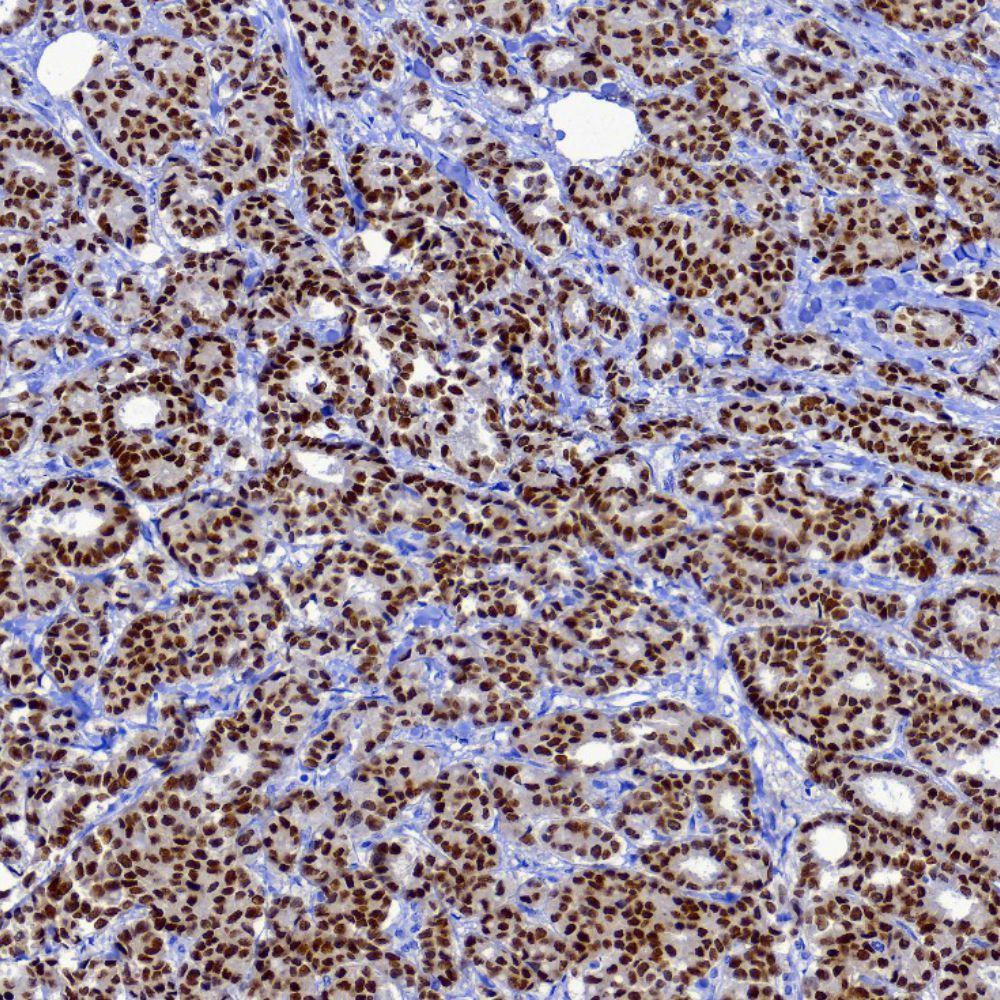 Breast ca stained with Anti-Estrogen Receptor (2)