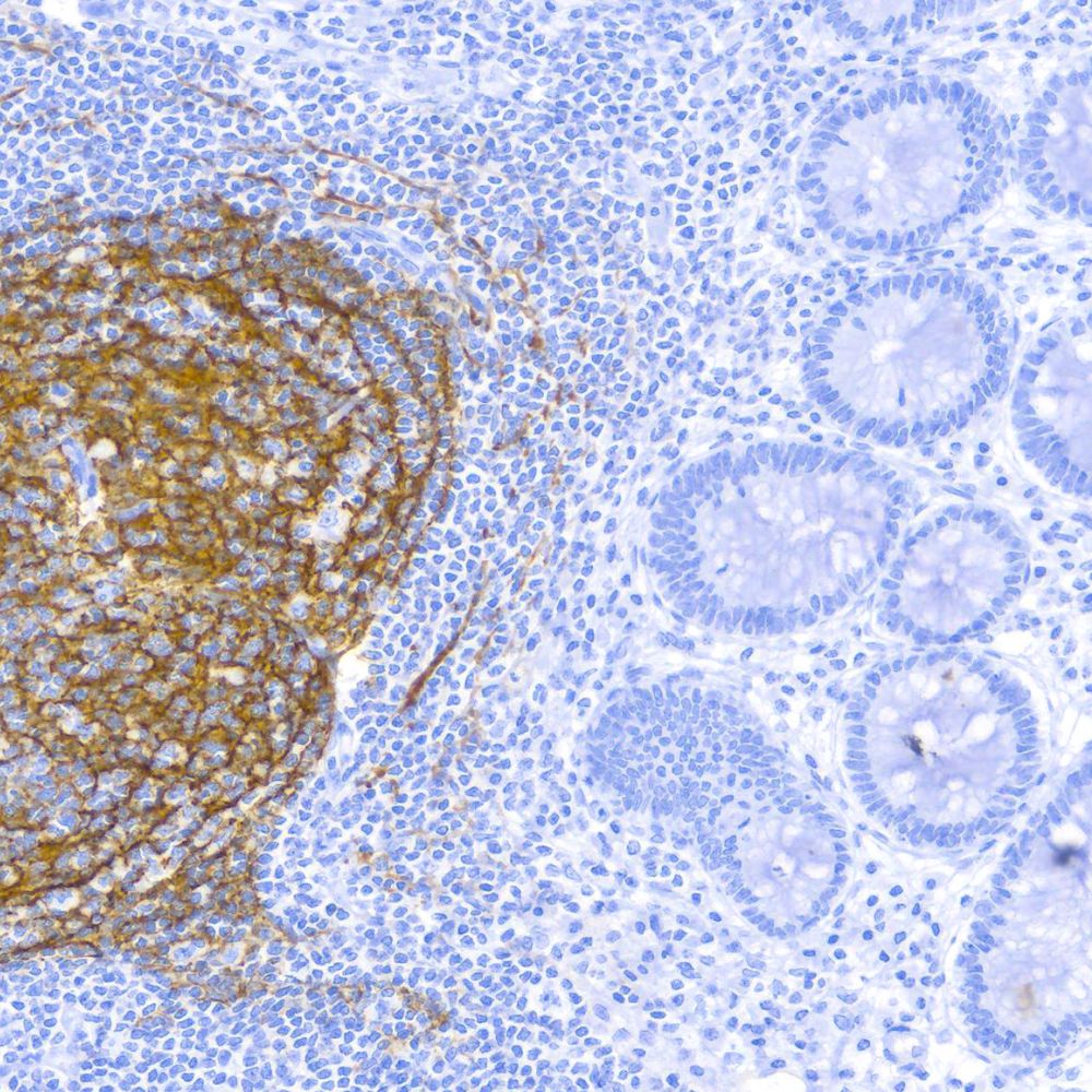Colon with polyp stained with Anti-CD21