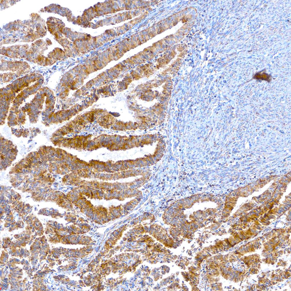 Endometrial carcinoma stained with Anti-SDHB