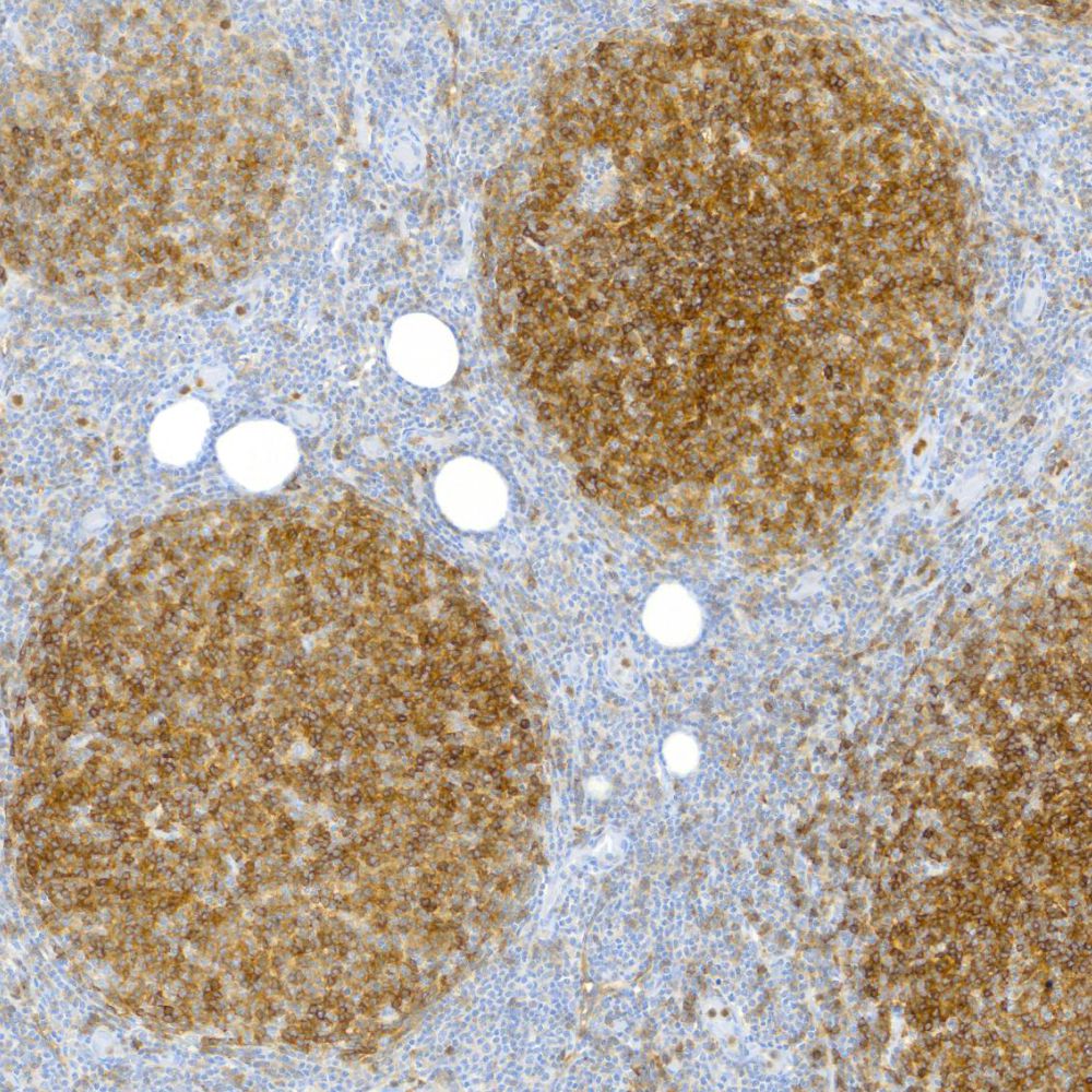 Follicular lymphoma stained with Anti-CD10