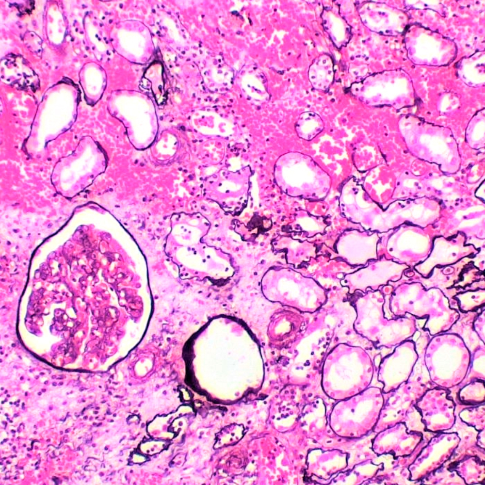 Jones Methanamine Silver_ 2 stained on Kidney with interstitial Nephritis