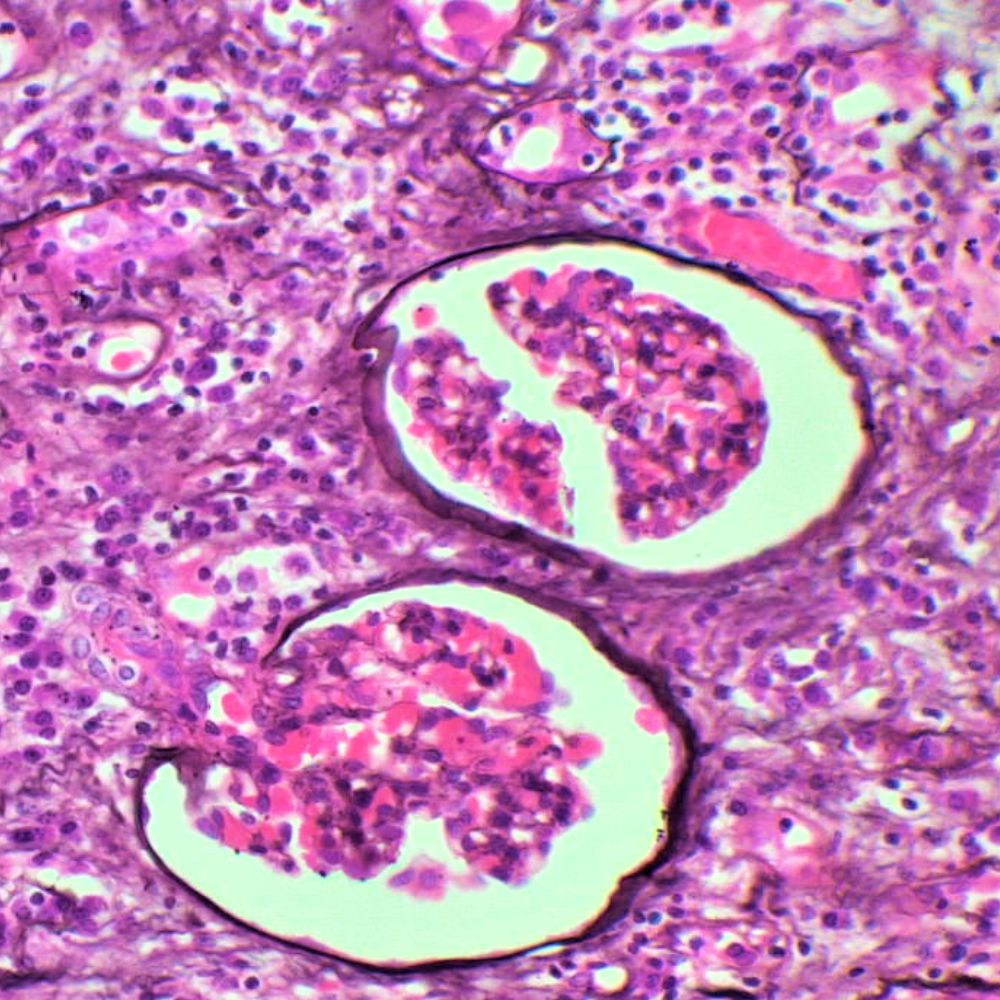 Jones Methanamine Silver_ 3 stained on Kidney with interstitial Nephritis