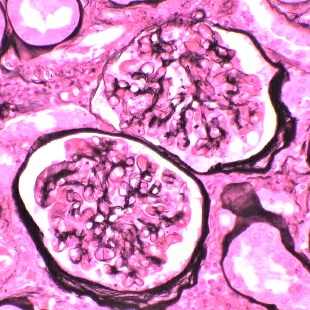 Jones Methanamine Silver_1 stained on Kidney with interstitial Nephritis