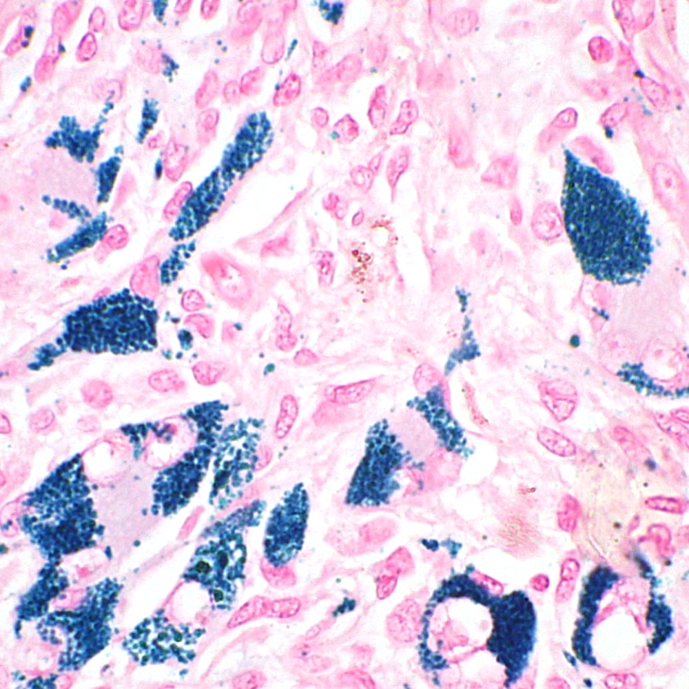 Perls Stain_ 2 stained on Giant cell tumour of tendon sheath