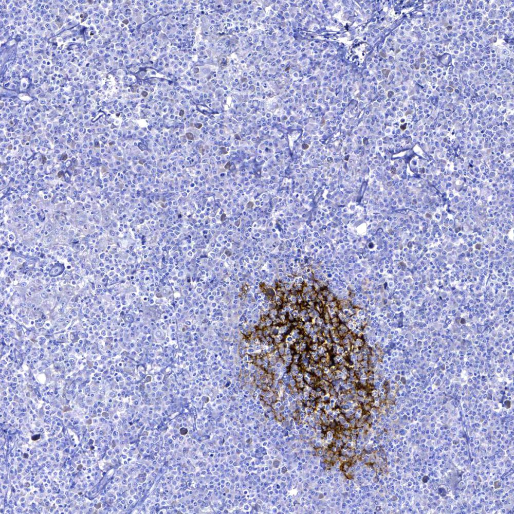 Plasmacytoma Stained with Anti-CD23