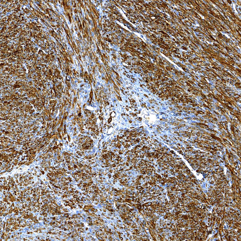 Symplastic leiomyoma Stained with Anti-Caldesmon