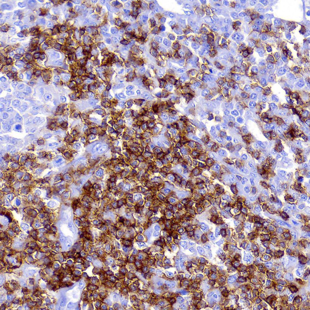 T-cell rich B-cell lymphoma stained with Anti-CD5